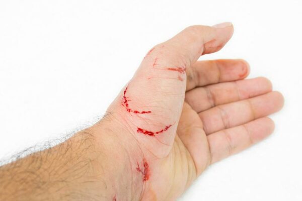10 Diseases Humans Can Get From Cats (Vet Answer) - Catster